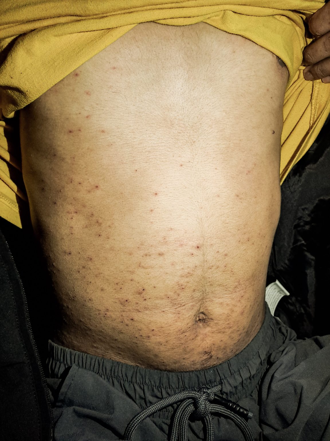 SARNA: UNA ENFERMEDAD CUTÁNEA DIFÍCIL DE ERRADICAR - No Name Kitchen